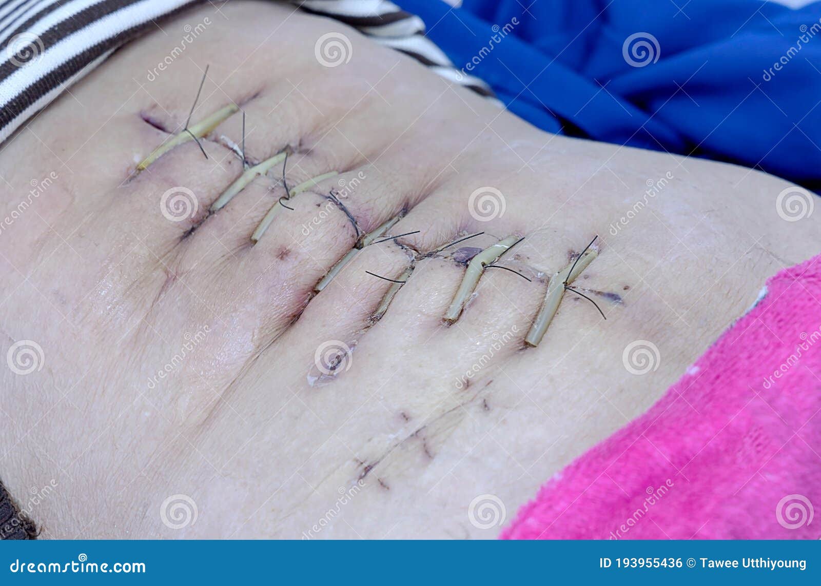 Abdominal surgering wound stock photo. Image of hospital - 193955436