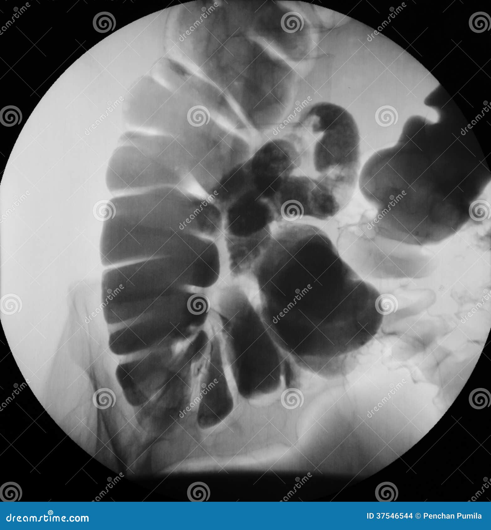 Colonoscopy Image.Internal Organs Anal Canal,sigmoid,descendind Colon ...