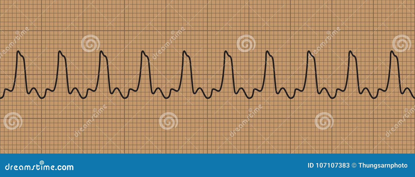 Abnormal Cardiogram Ventricular Tachycardia Stock Vector - Illustration ...