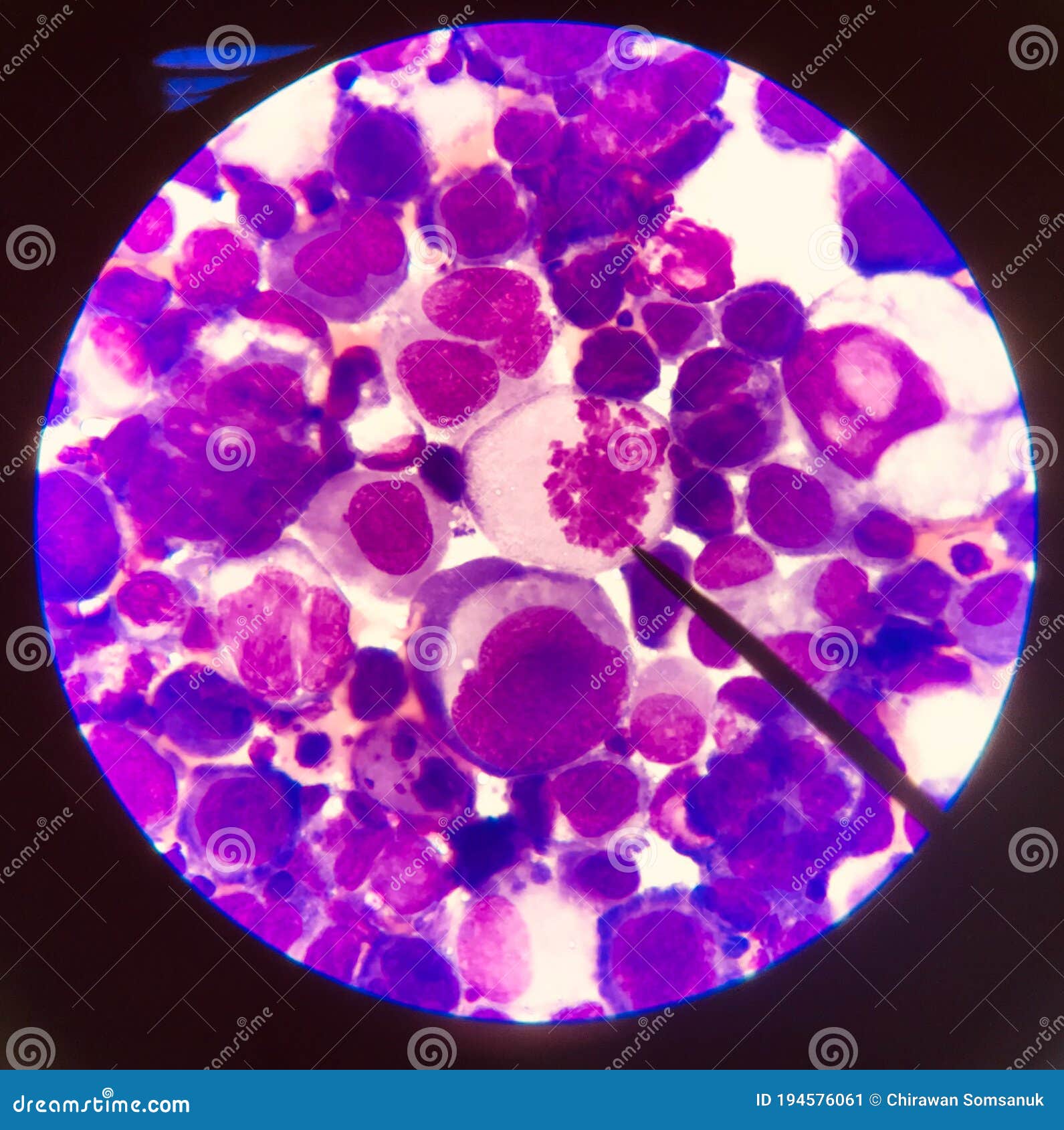Abnormal Cell Blood Smear Science Concept Stock Image - Image of ... Abnormal Cell Blood Smear Science Concept Stock Image - Image of ...