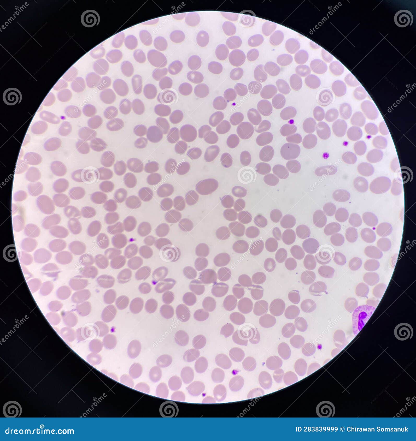 Abnormal Cell Blood Smear Science Concept Stock Image | CartoonDealer ...