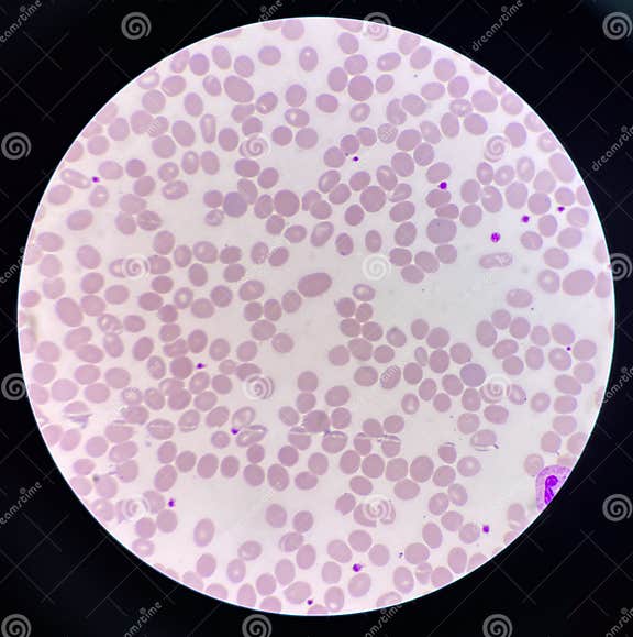 Abnormal Cell Macro Ovalocyte Stock Image - Image of erythrocyte ...