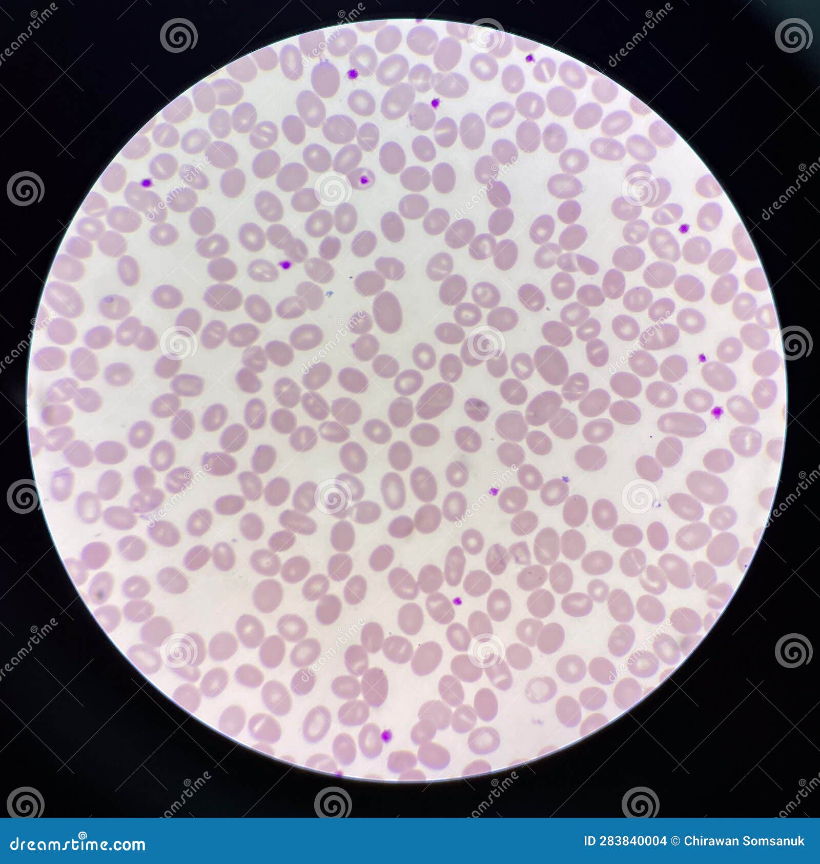 Abnormal Cell Blood Smear Science Concept Stock Image | CartoonDealer ...
