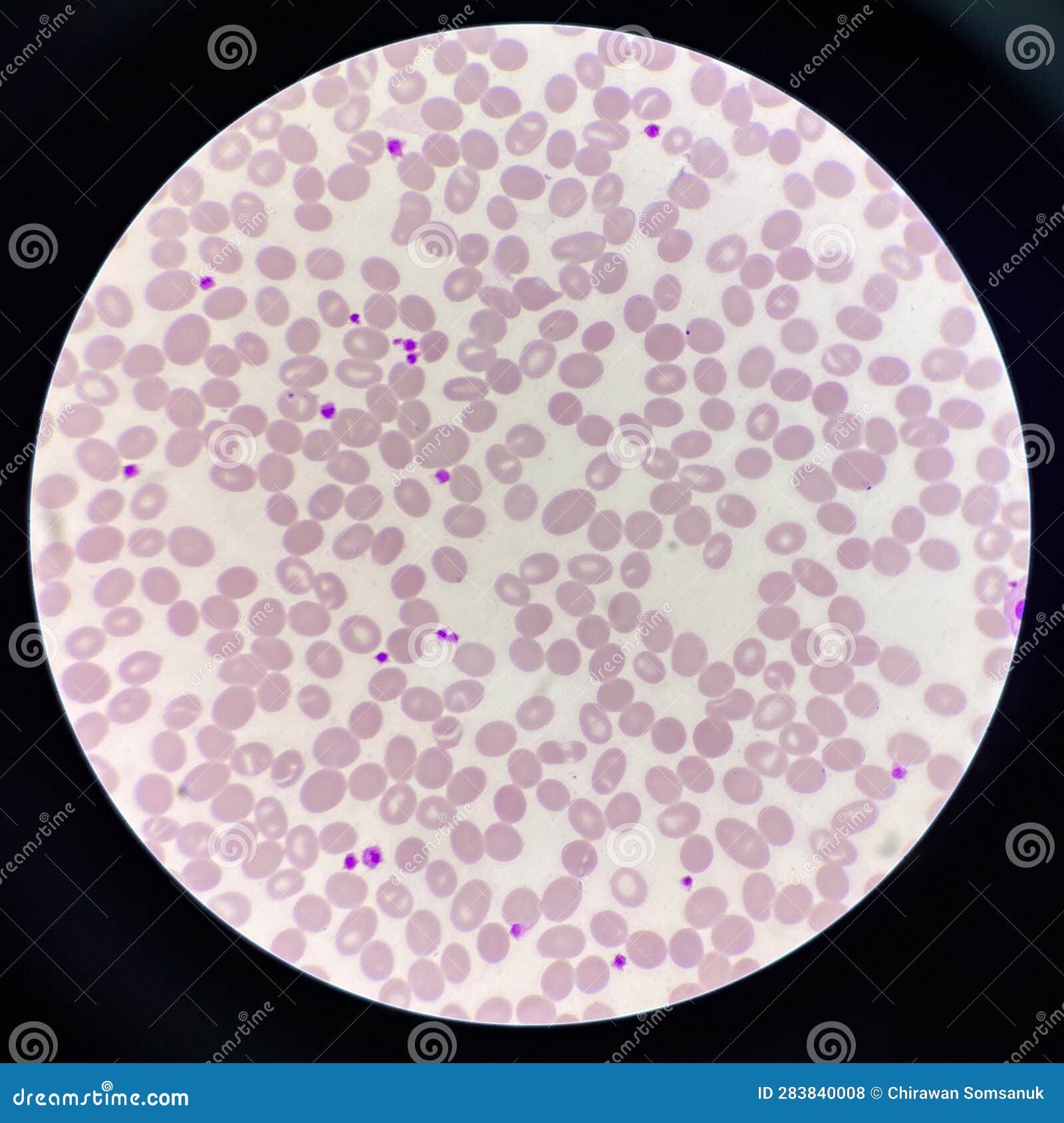 Abnormal Cell Blood Smear Science Concept Stock Image | CartoonDealer ...