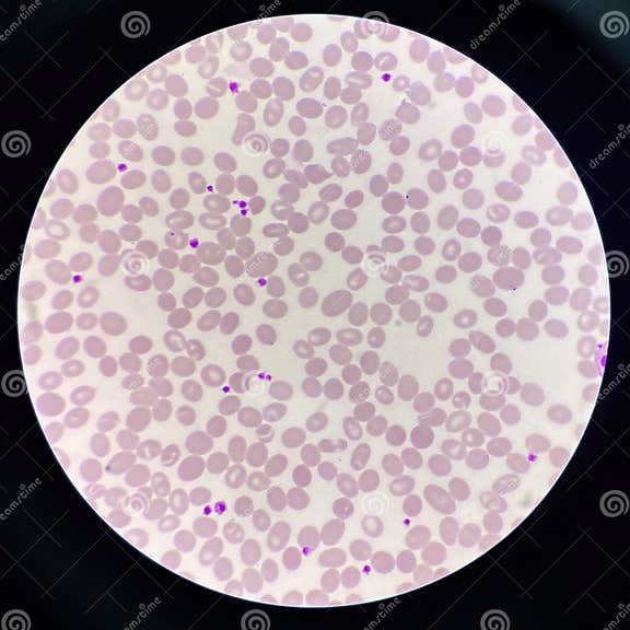 Abnormal Cell Macro Ovalocyte Stock Photo - Image of hemoglobin ...