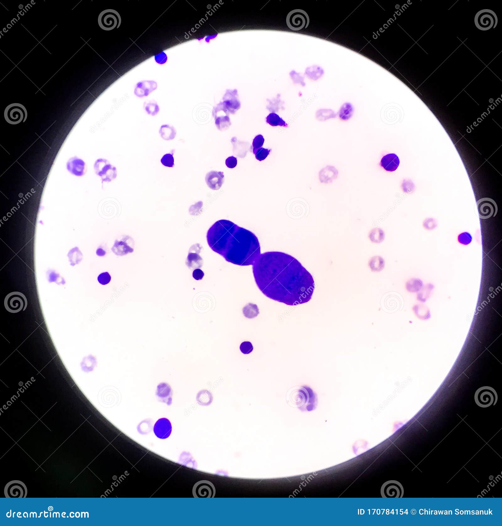 Abnormal Cells in Pleural Fluid Stock Photo - Image of abstract, health ...
