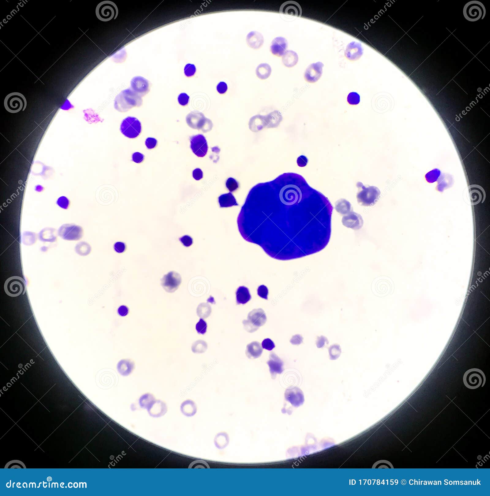 Abnormal Cells in Pleural Fluid Stock Image - Image of abstract, cells ...