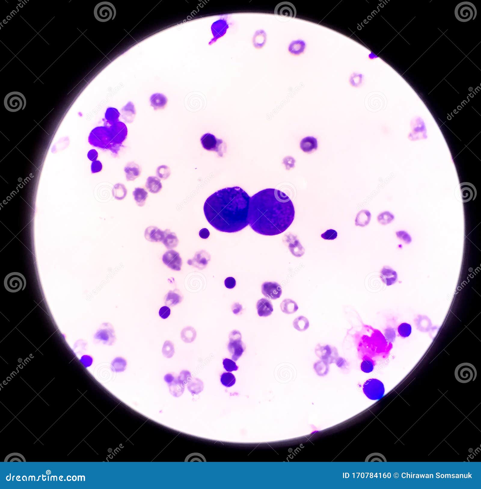 Abnormal Cells In Pleural Fluid Royalty-Free Stock Photography ...