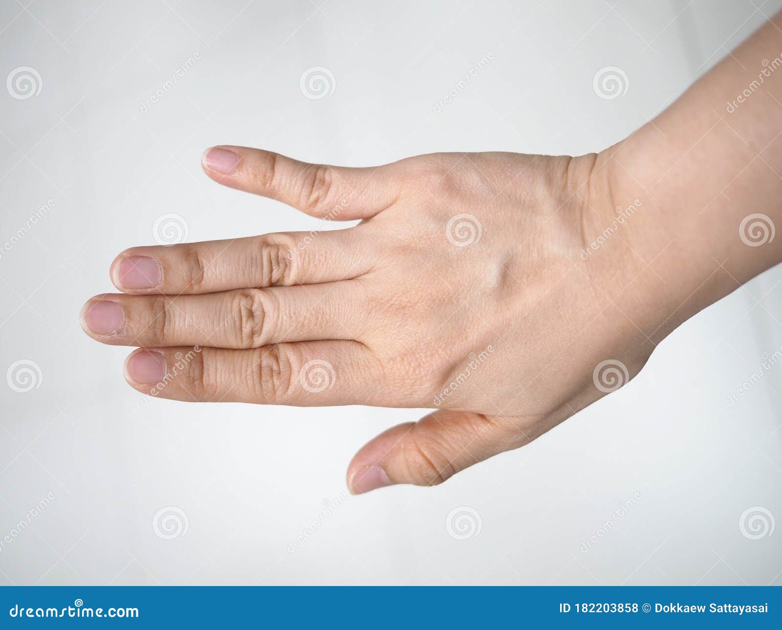 Abnormal Finger Alignment Due To Accident Stock Photography ...