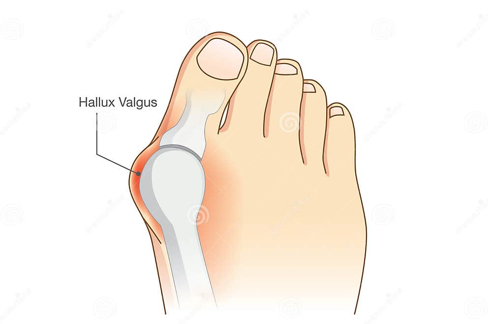 Abnormal of Foot Shape from Deformity Joint Toe. Stock Vector ...