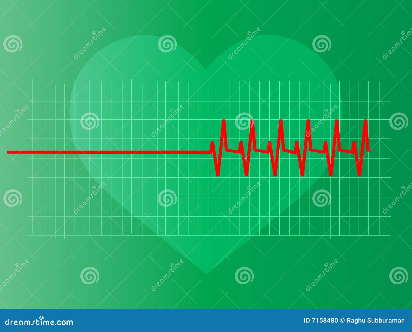 Abnormal Cardiogram Ventricular Tachycardia Cartoon Vector ...