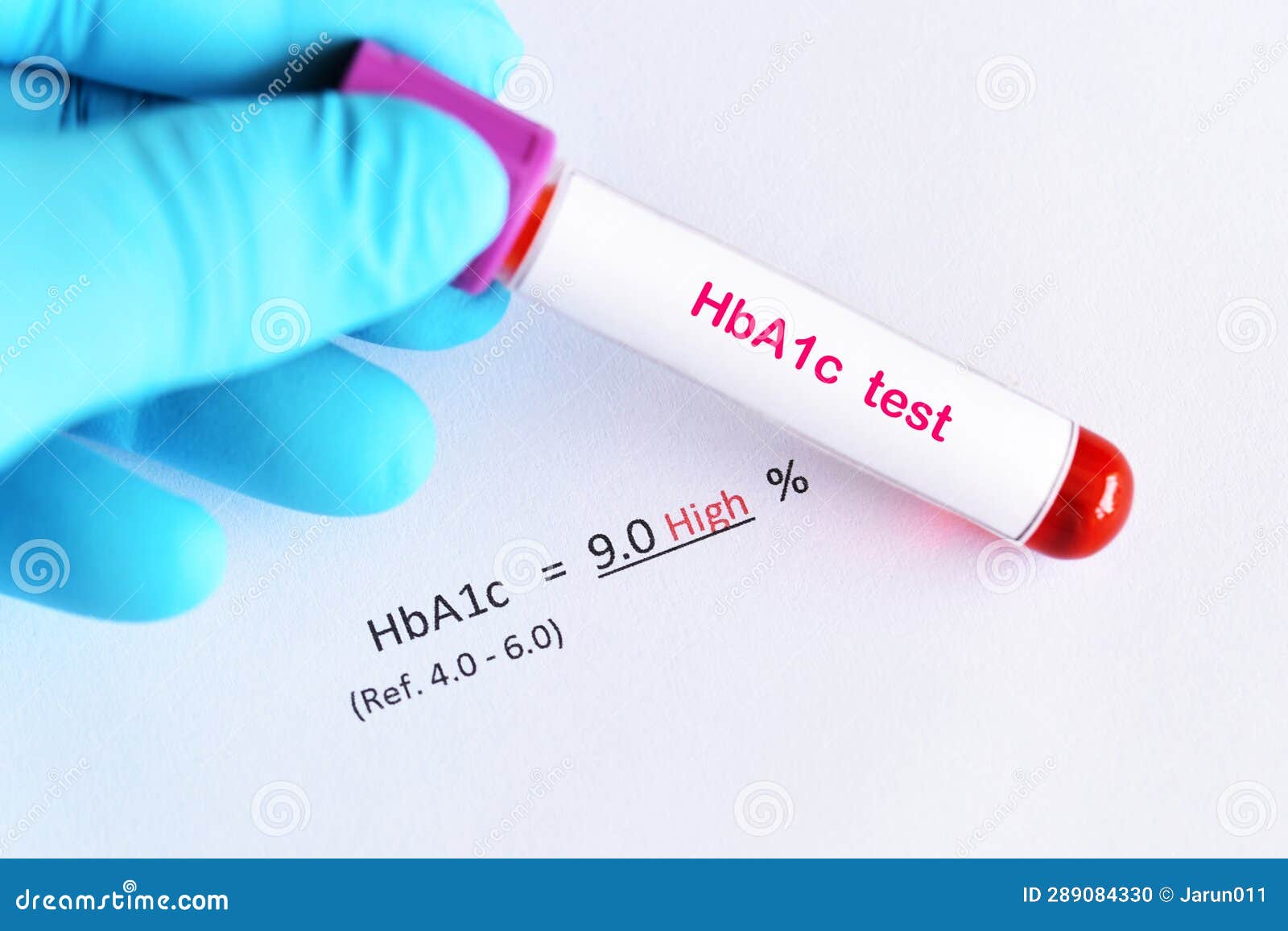 Abnormal High HbA1c Test Result Stock Photo - Image of laboratory, test ...