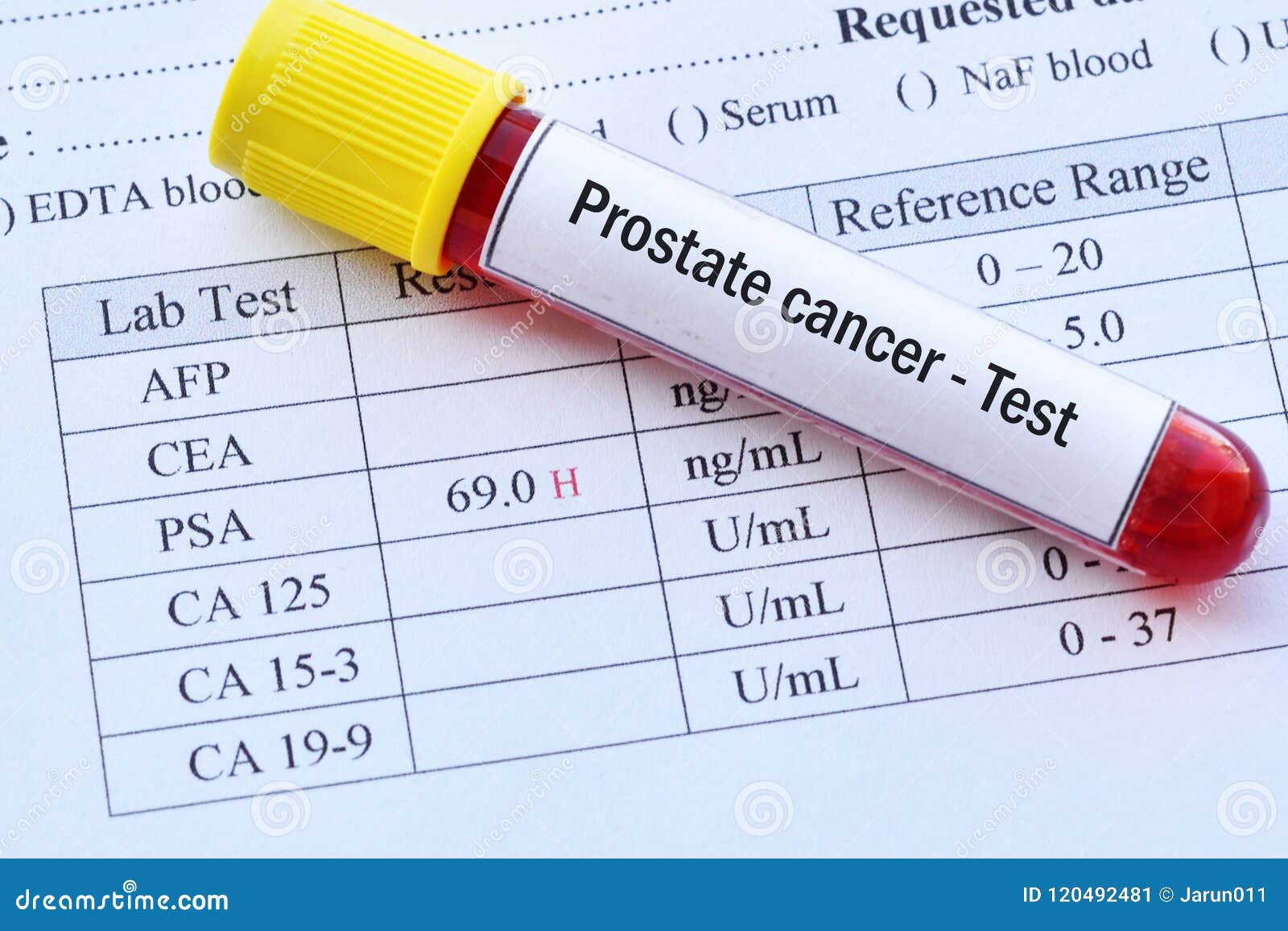 Abnormal High PSA Test Result Stock Image - Image of cancer, medicine ...
