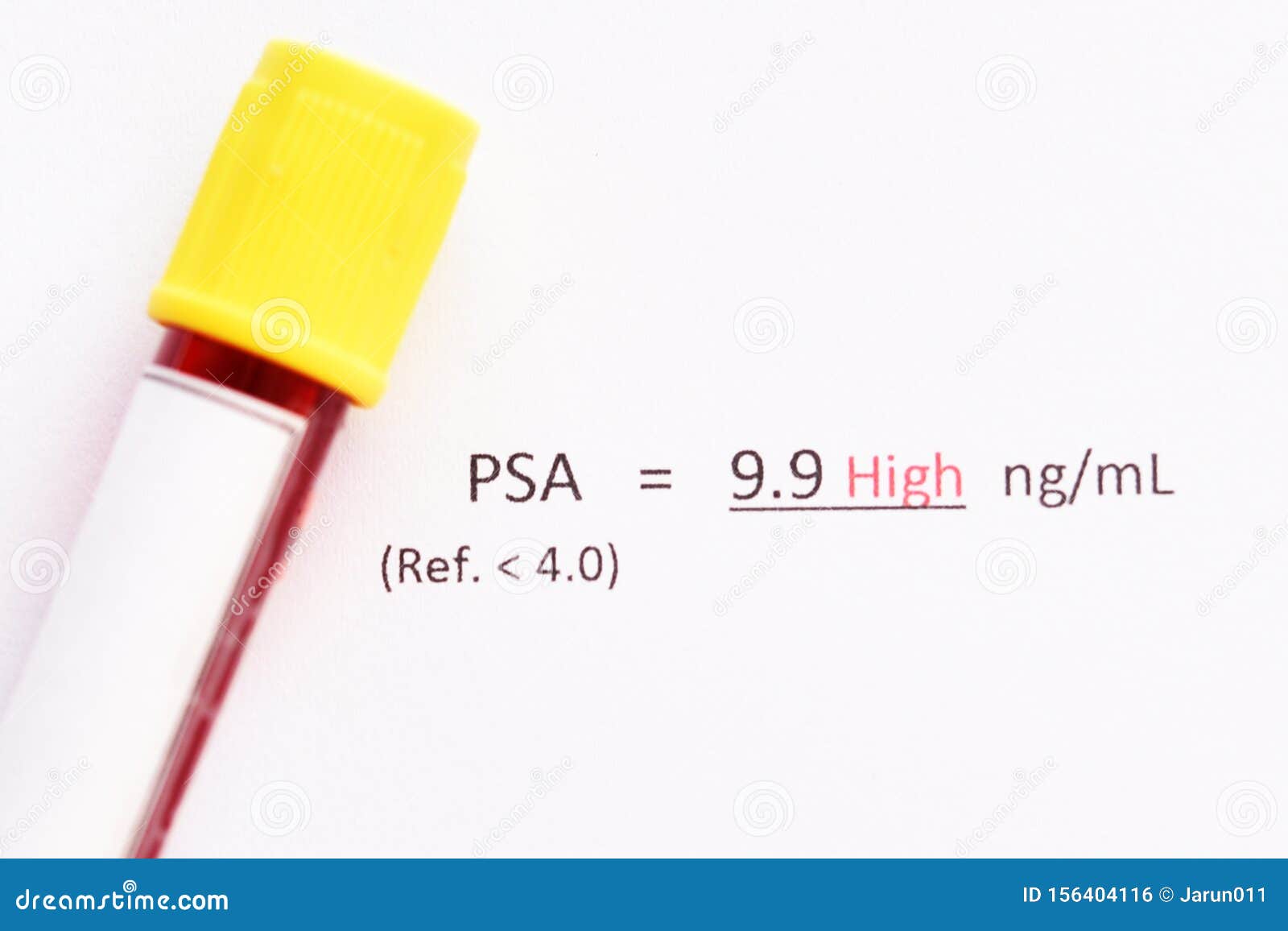 Abnormal High PSA Test Result Stock Photo - Image of antigen, cancer ...
