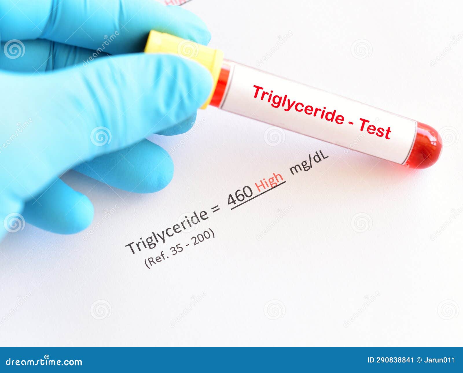 Abnormal High Triglyceride Result Stock Image - Image of lipoprotein ...