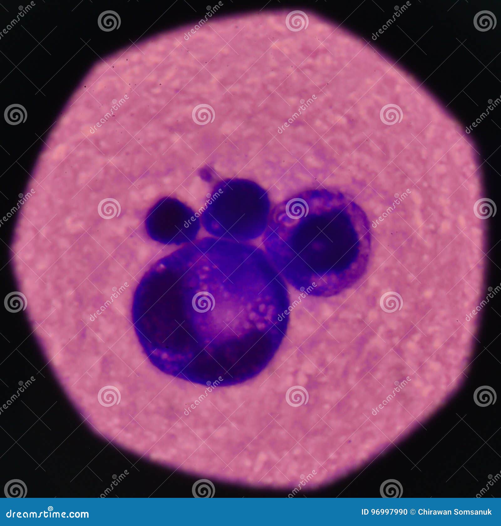 Malignant Cells, Photo Under Microscope Royalty-Free Stock Image ...