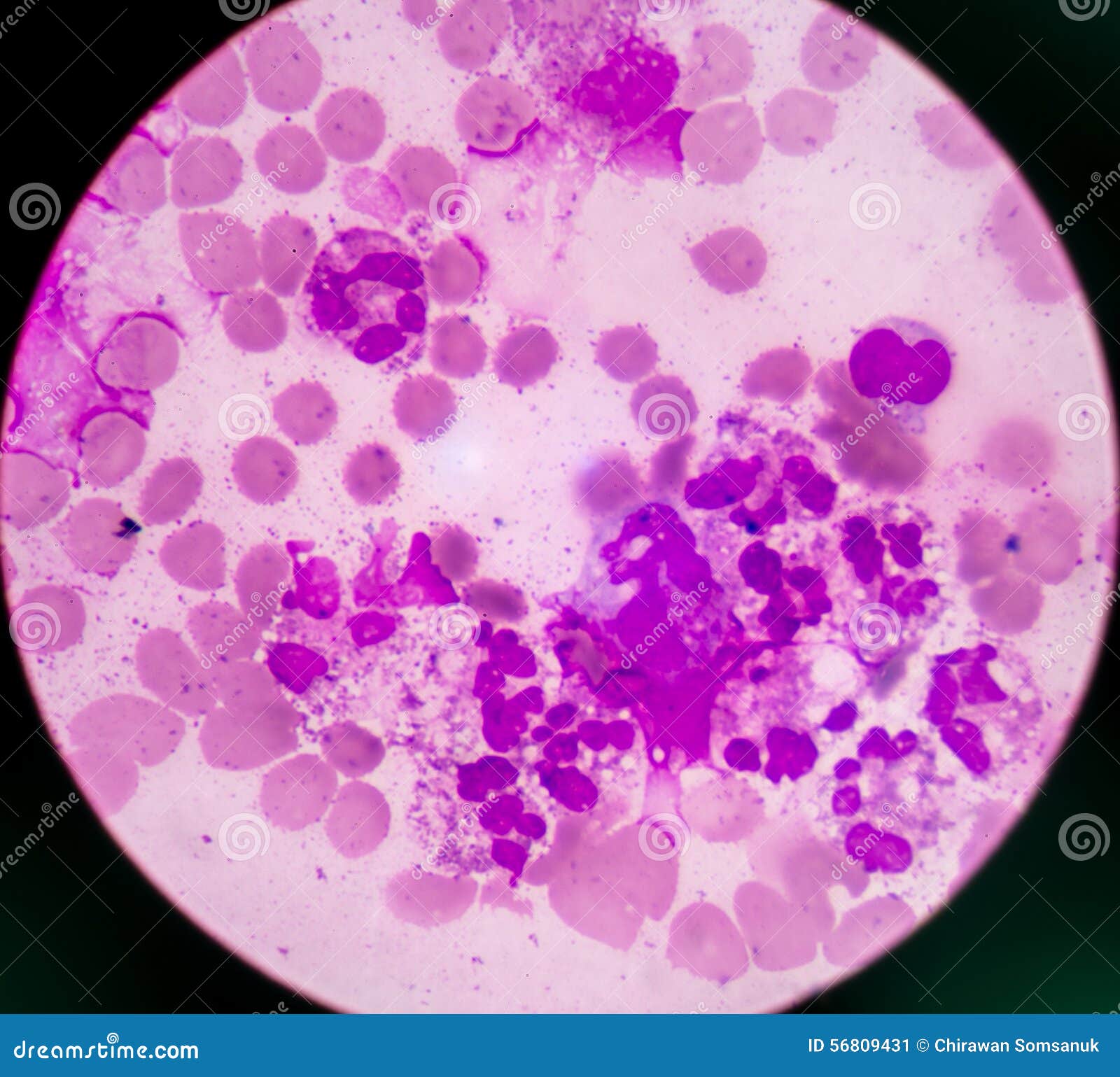 Abnormal neutrophil stock image. Image of biology, lobed - 56809431