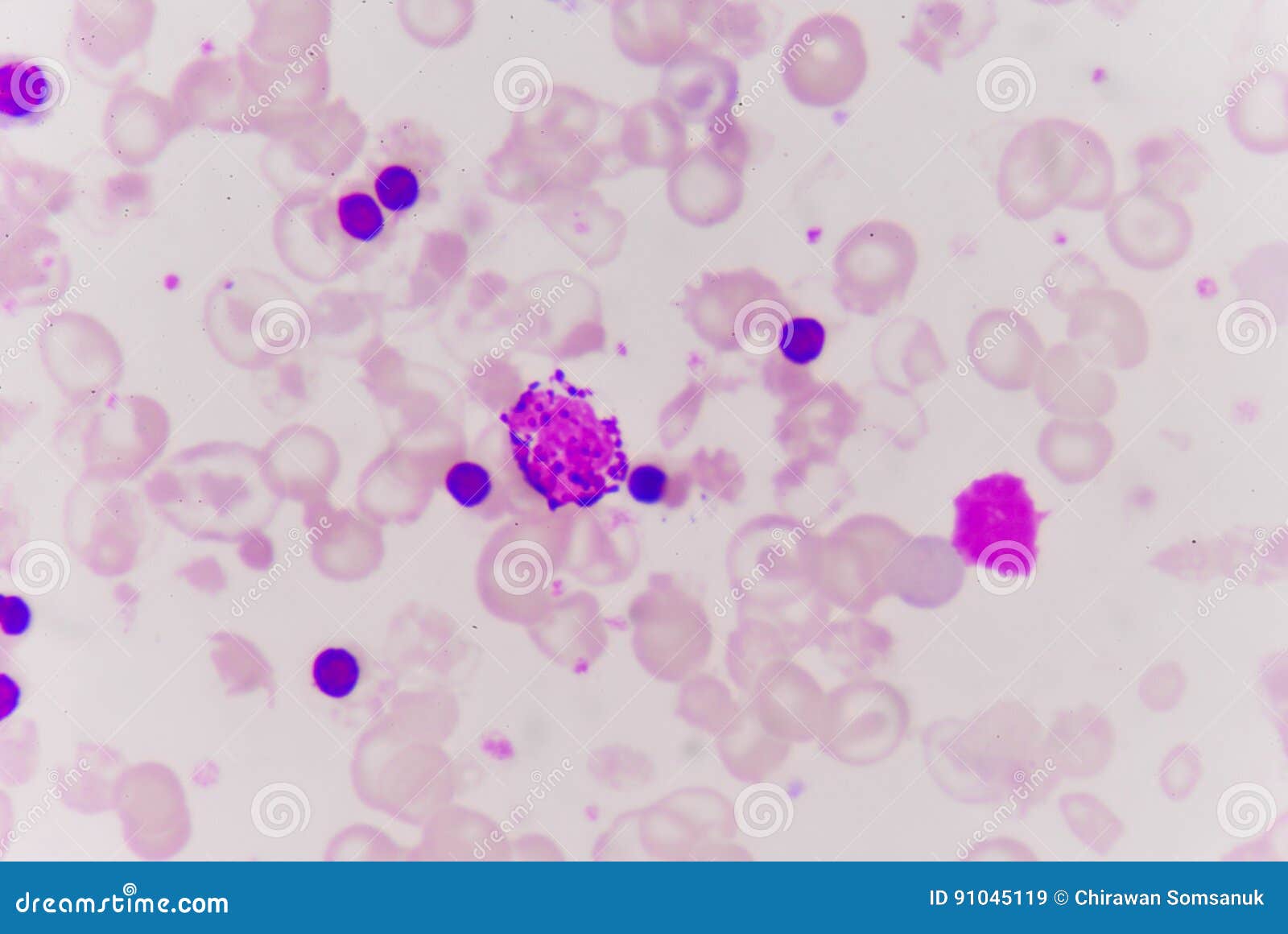Abnormal red blood cells stock image. Image of laboratory - 91045119