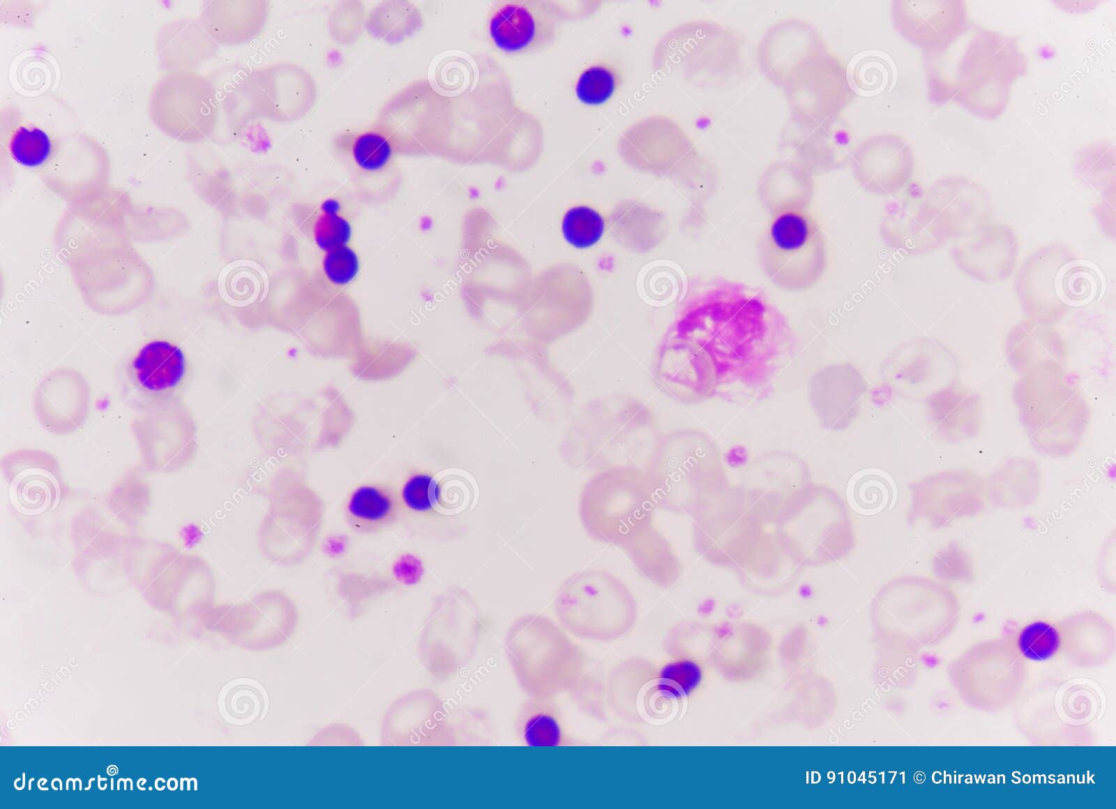 Nucleated Red Blood Cells NRC In Blood Smear Stock Photo ...