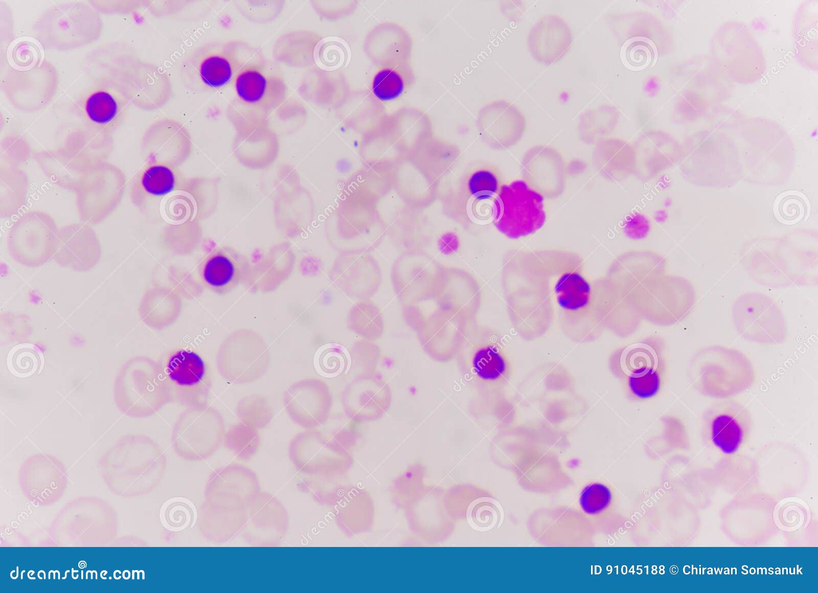 Nucleated Red Blood Cells NRC In Blood Smear Stock Photo ...