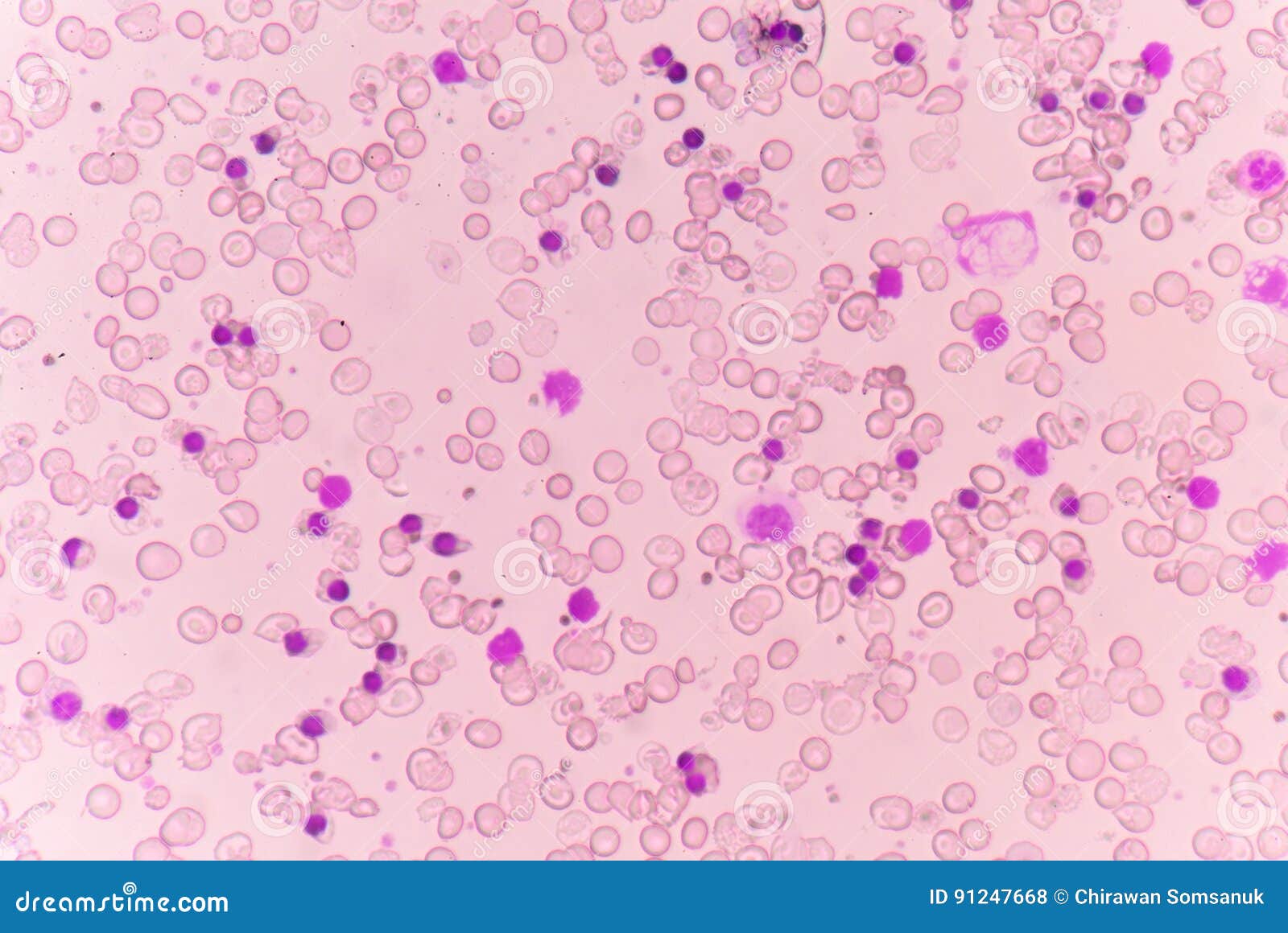 Abnormal Shaped Red Blood Cells