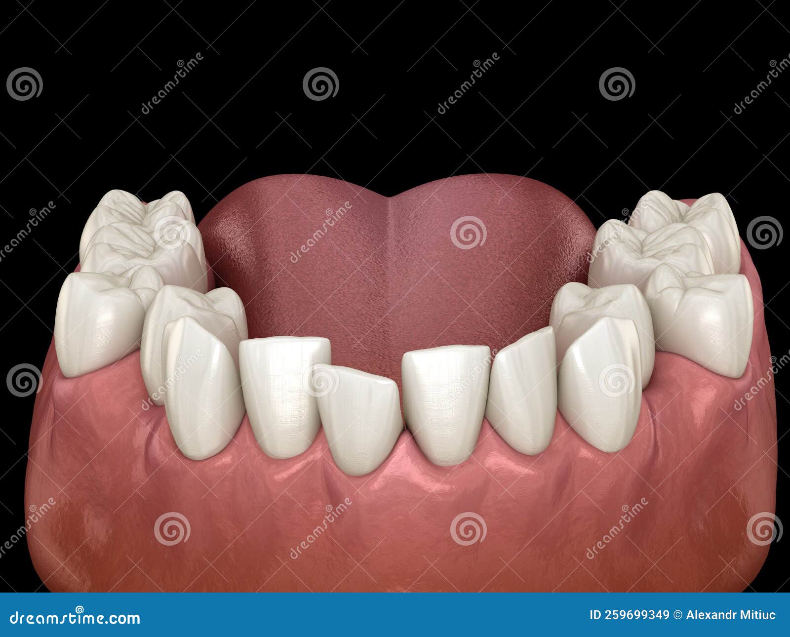 Abnormal Teeth Position, Orthodontic Concept. Medically Accurate Tooth ...