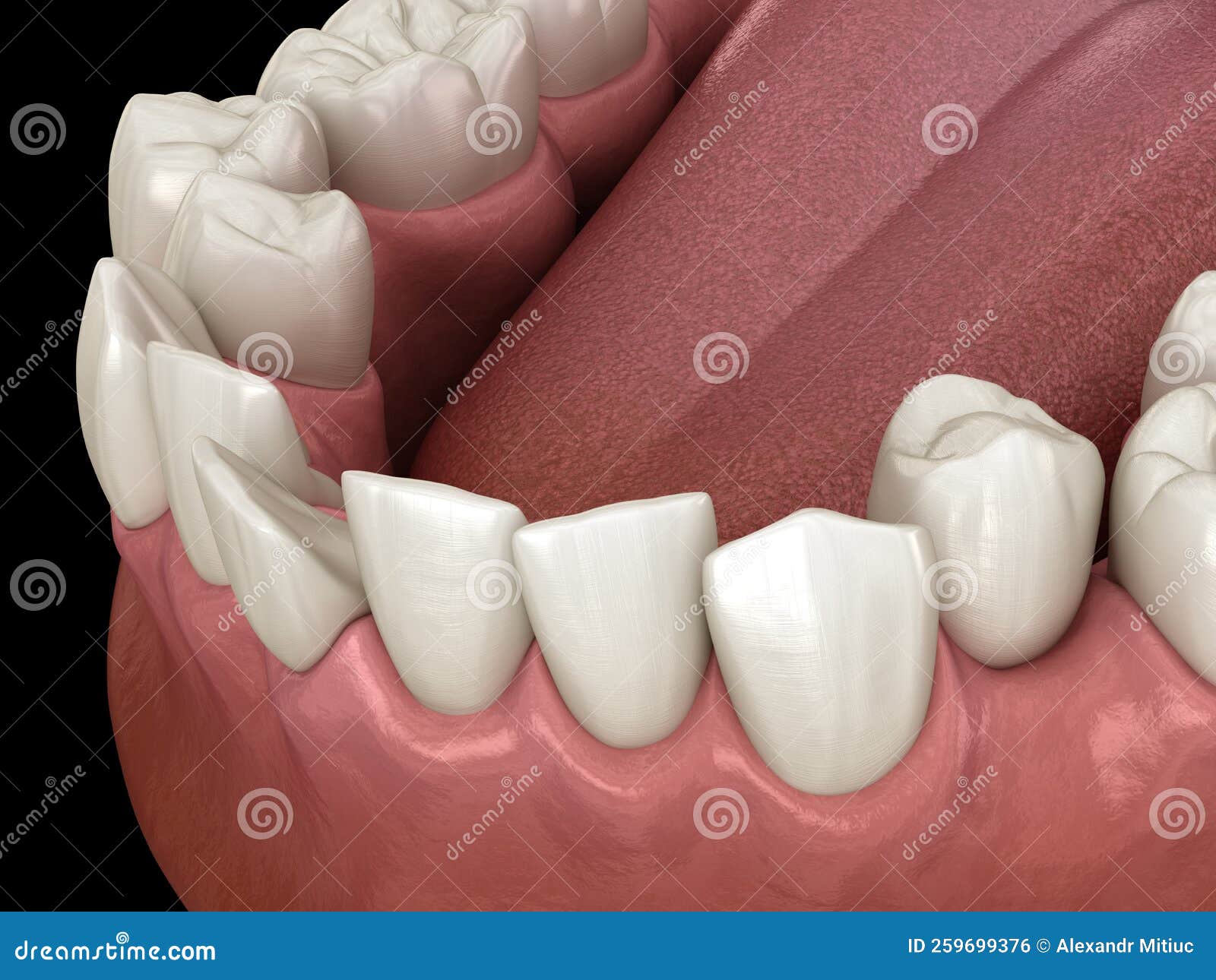 Abnormal Teeth Position, Orthodontic Concept. Medically Accurate Tooth ...