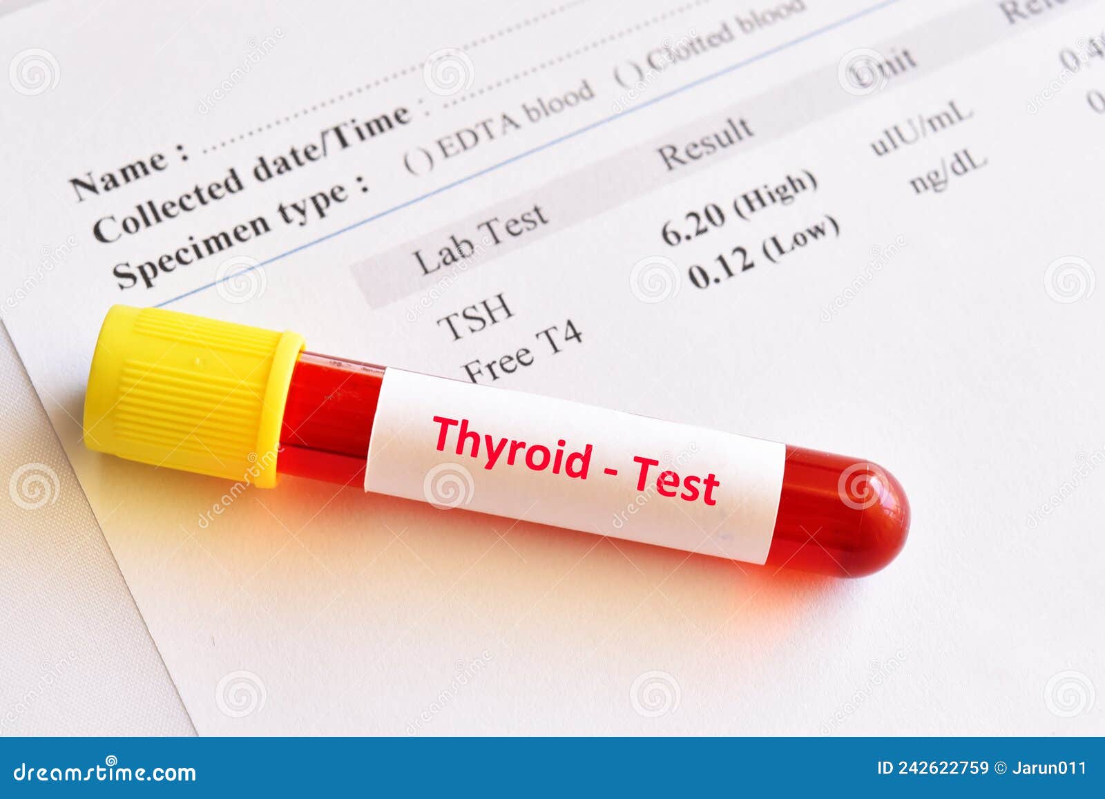 Abnormal Thyroid Hormone Test Result Stock Image - Image of health ...