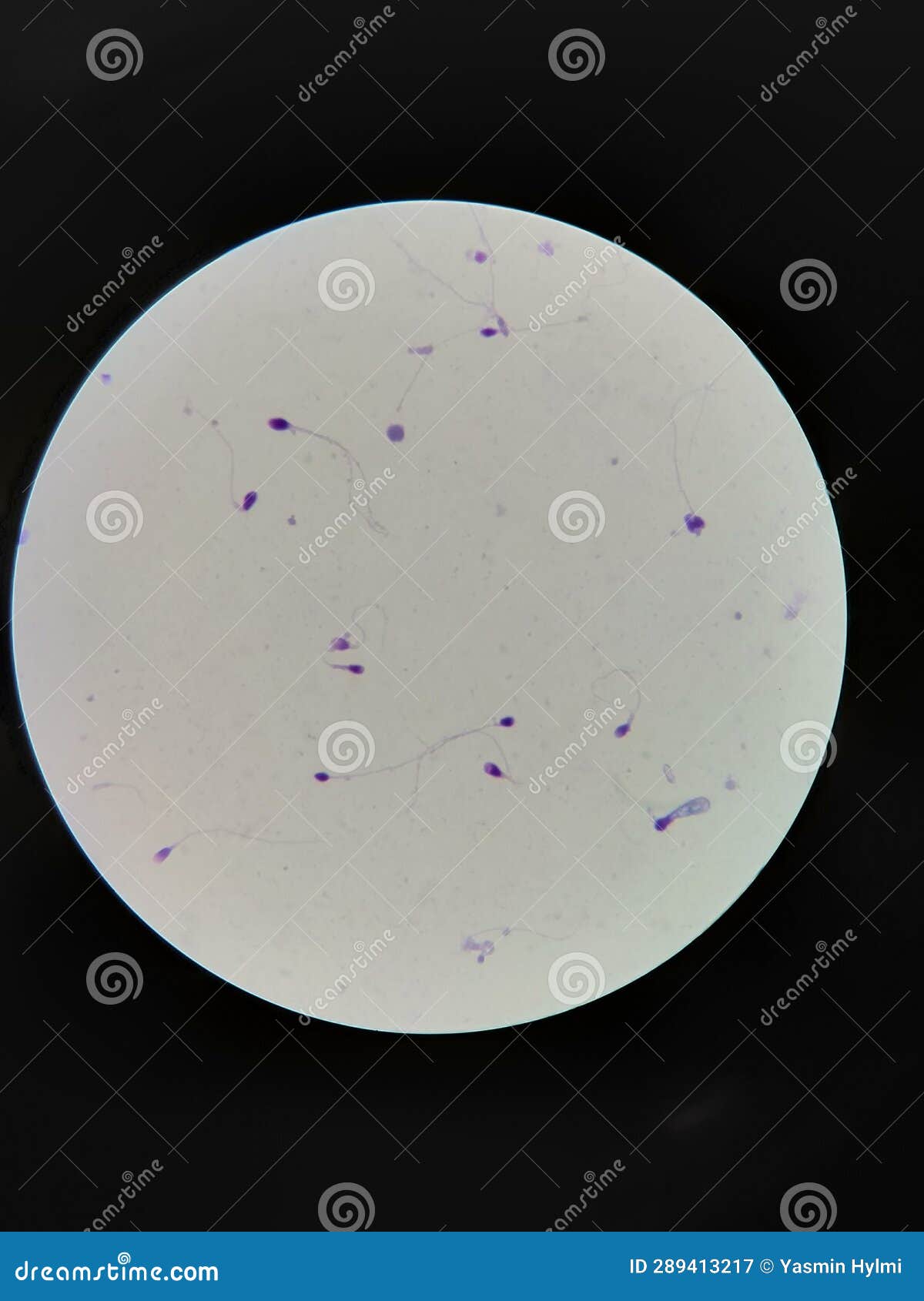 Abnormality of Sperm or Spermatozoa Morphology in Semen Analysis Stock ...