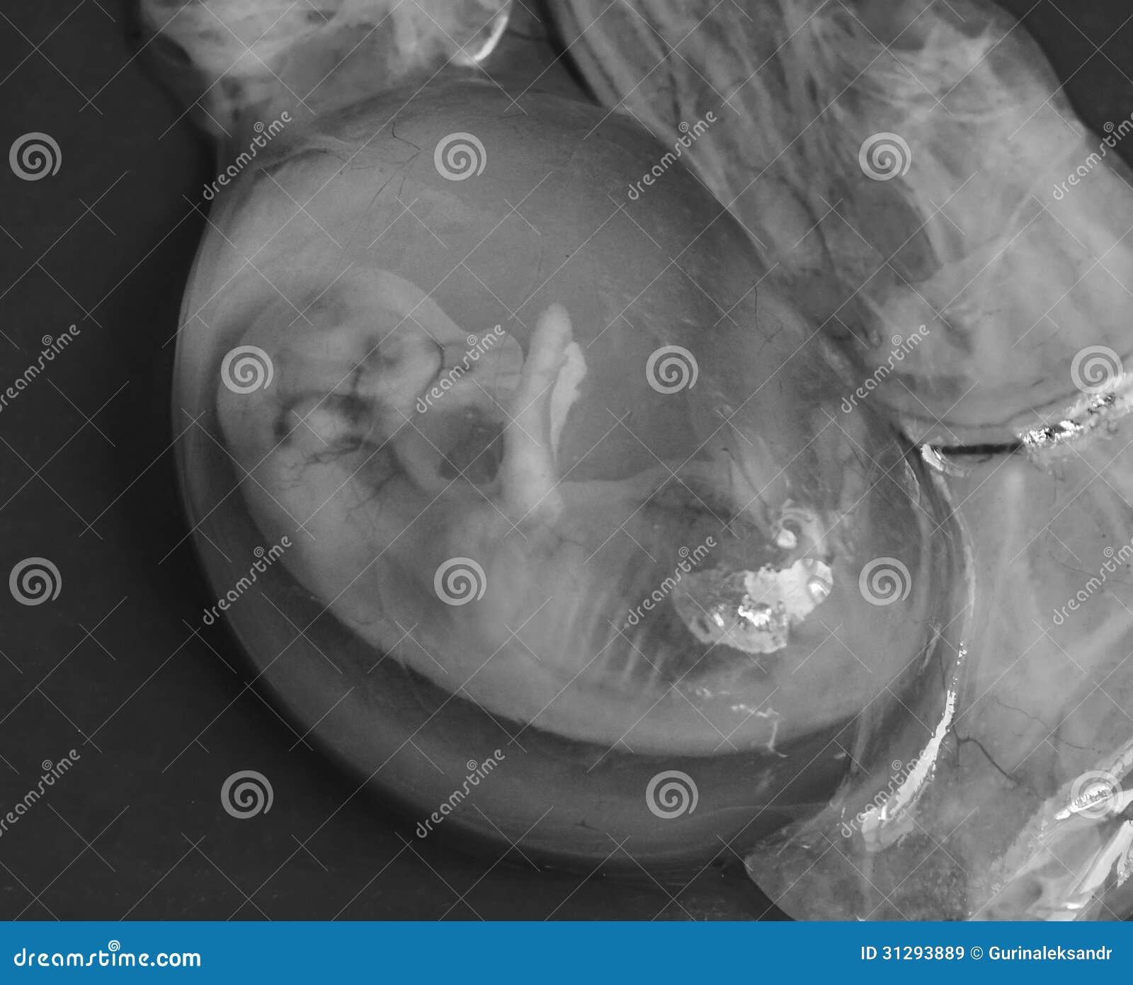 Aborted embryo stock image. Image of anatomy, abortion - 31293889