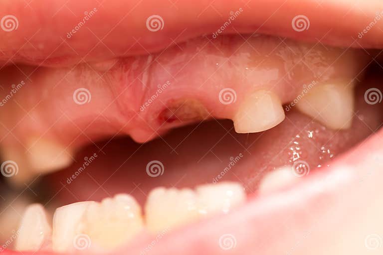 Abra O Menino Da Boca Sem Dentes Foto de Stock - Imagem de fofofo ...