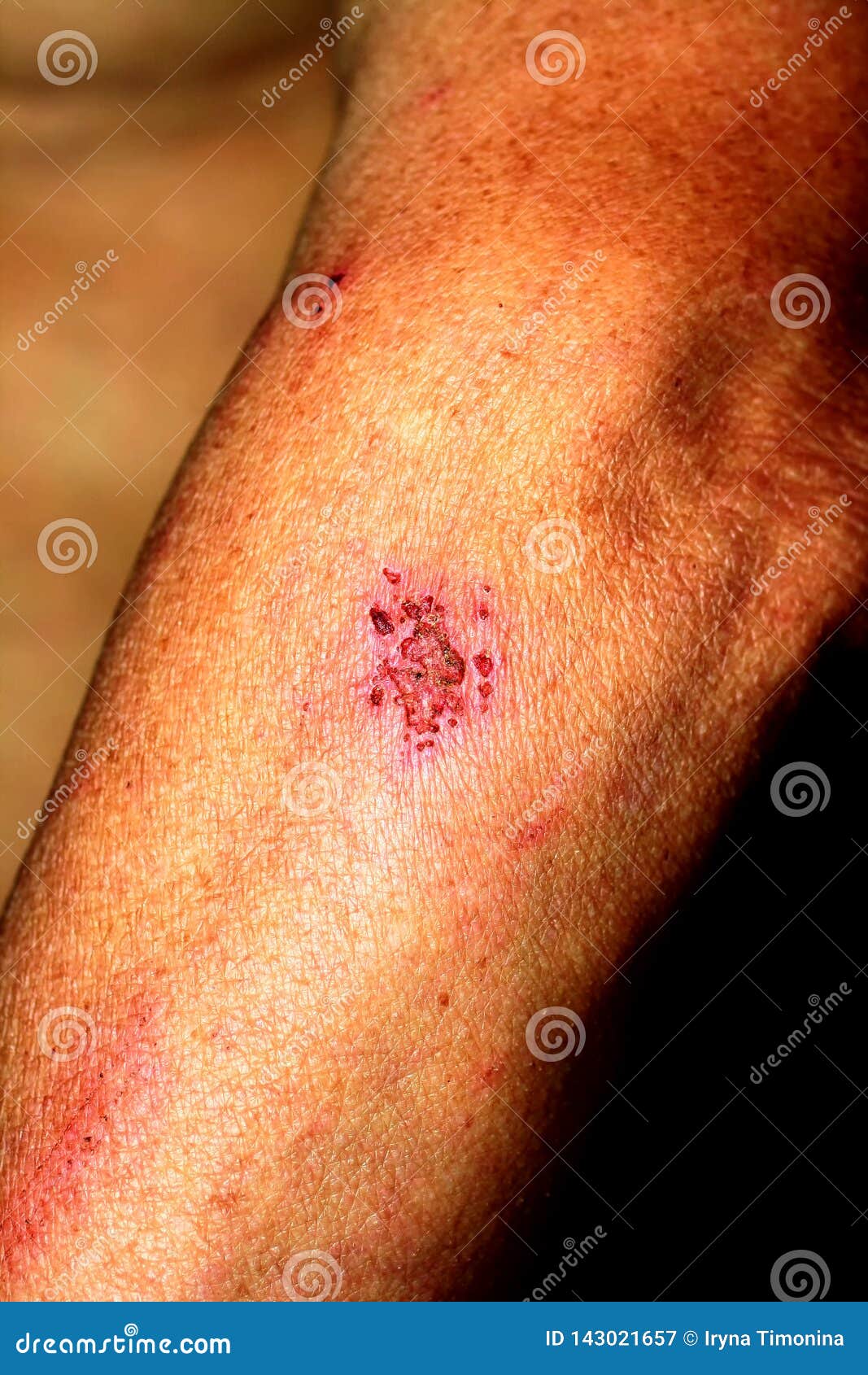 Abrasion on the Arm. Wound on the Elbow. Stock Image - Image of medical ...