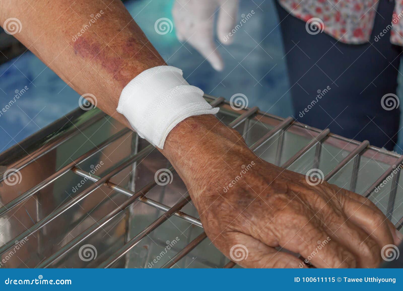 Abrasion wound arm stock image. Image of hurt, bleeding - 100611115