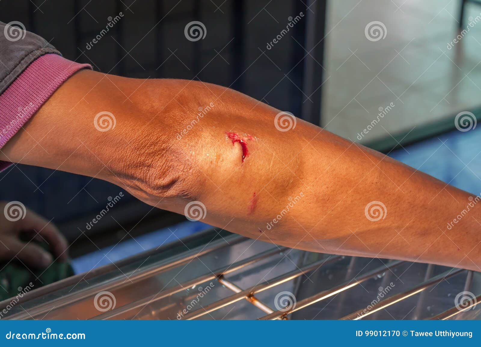 Abrasion wound arm injury stock photo. Image of burn - 99012170