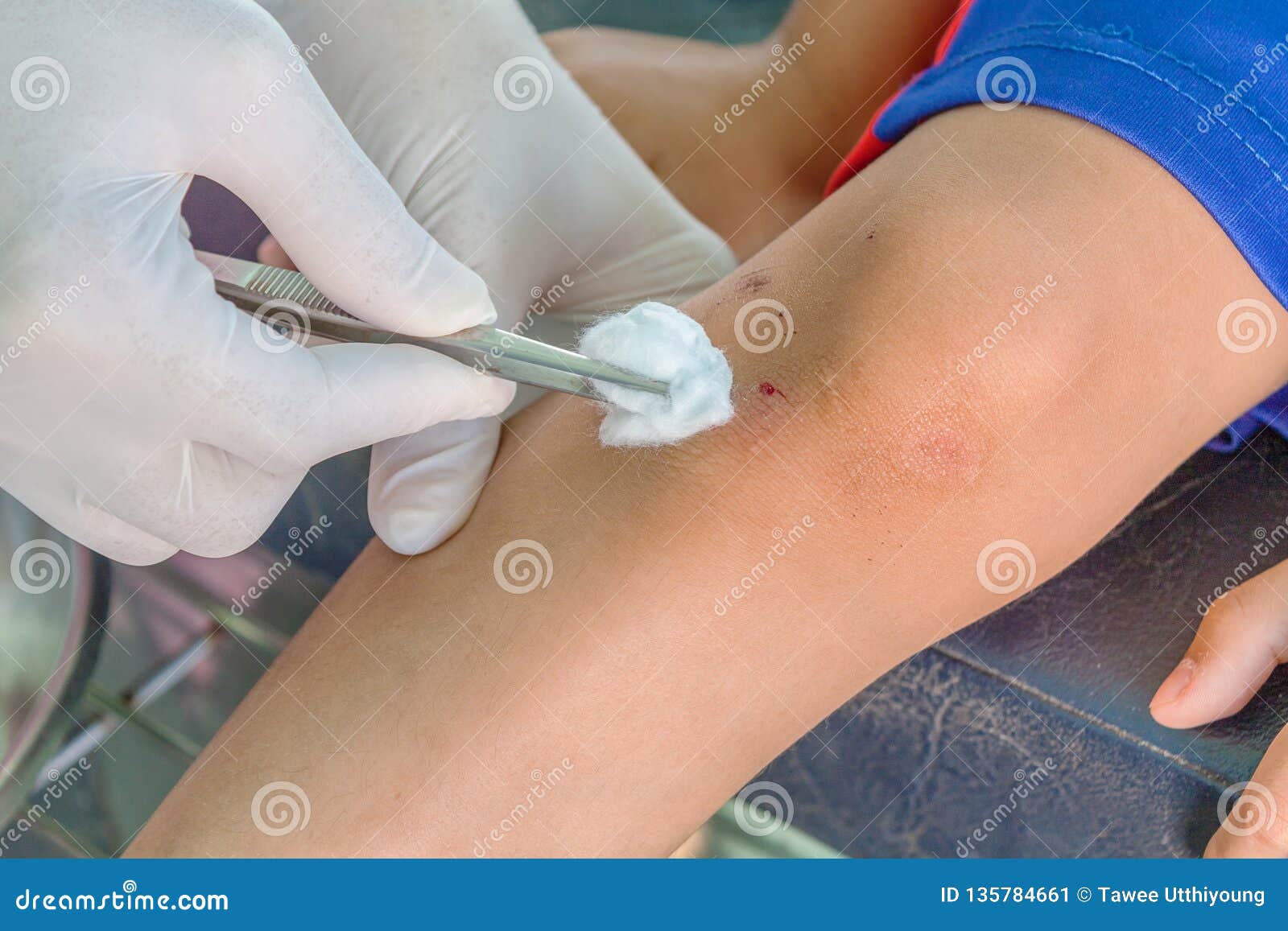 The Wound On The Child`s Leg . Fell On The Road. Broken Knee. Health ...