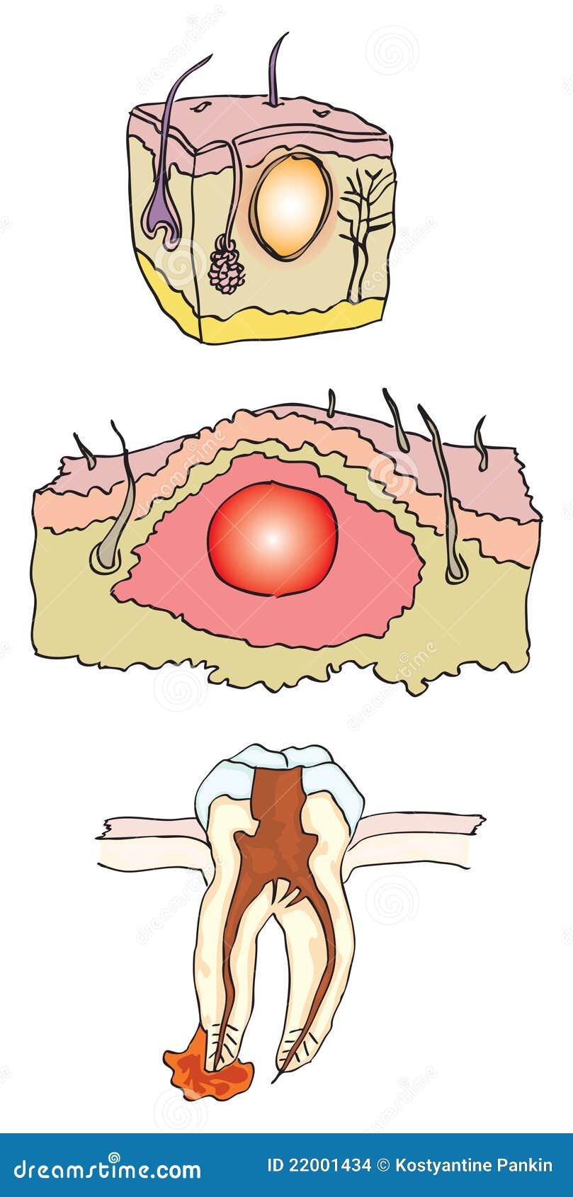 Absceso ilustración del vector. Ilustración de neoplasma - 22001434