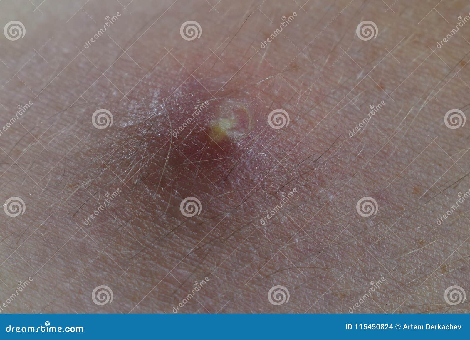 Absceso Purulento En La Piel Foto de archivo - Imagen de ampolla, punto ...