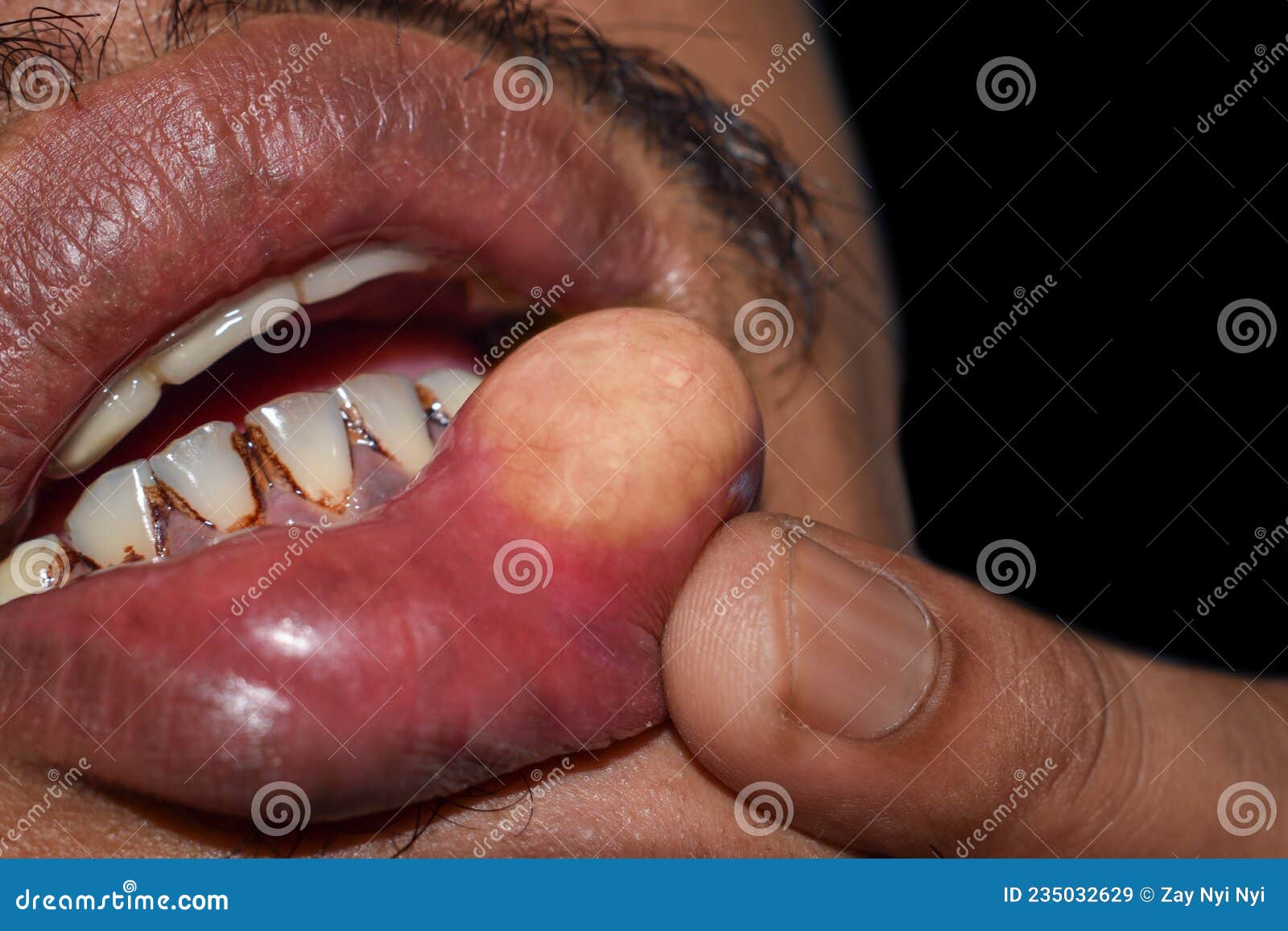 Abscess or Cyst with Pus at Lip Stock Image - Image of background ...