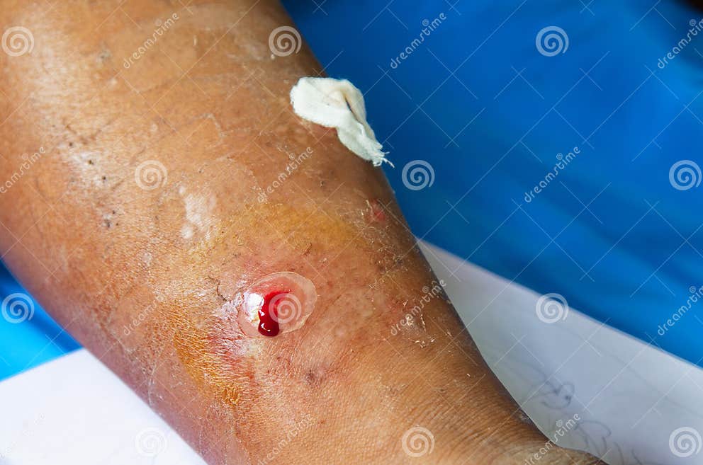Abscess leg dressing. stock image. Image of care, closeup - 43444601