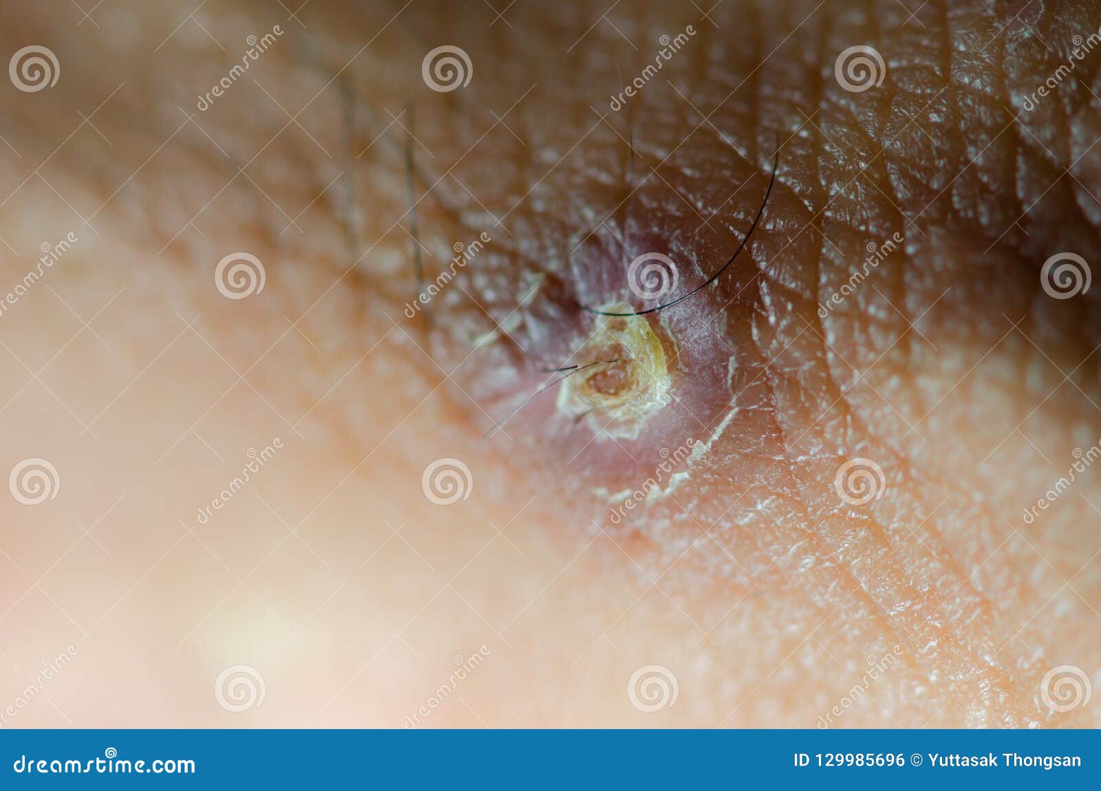 Abscess on Man Hand,select Focus Stock Photo - Image of care, macro ...