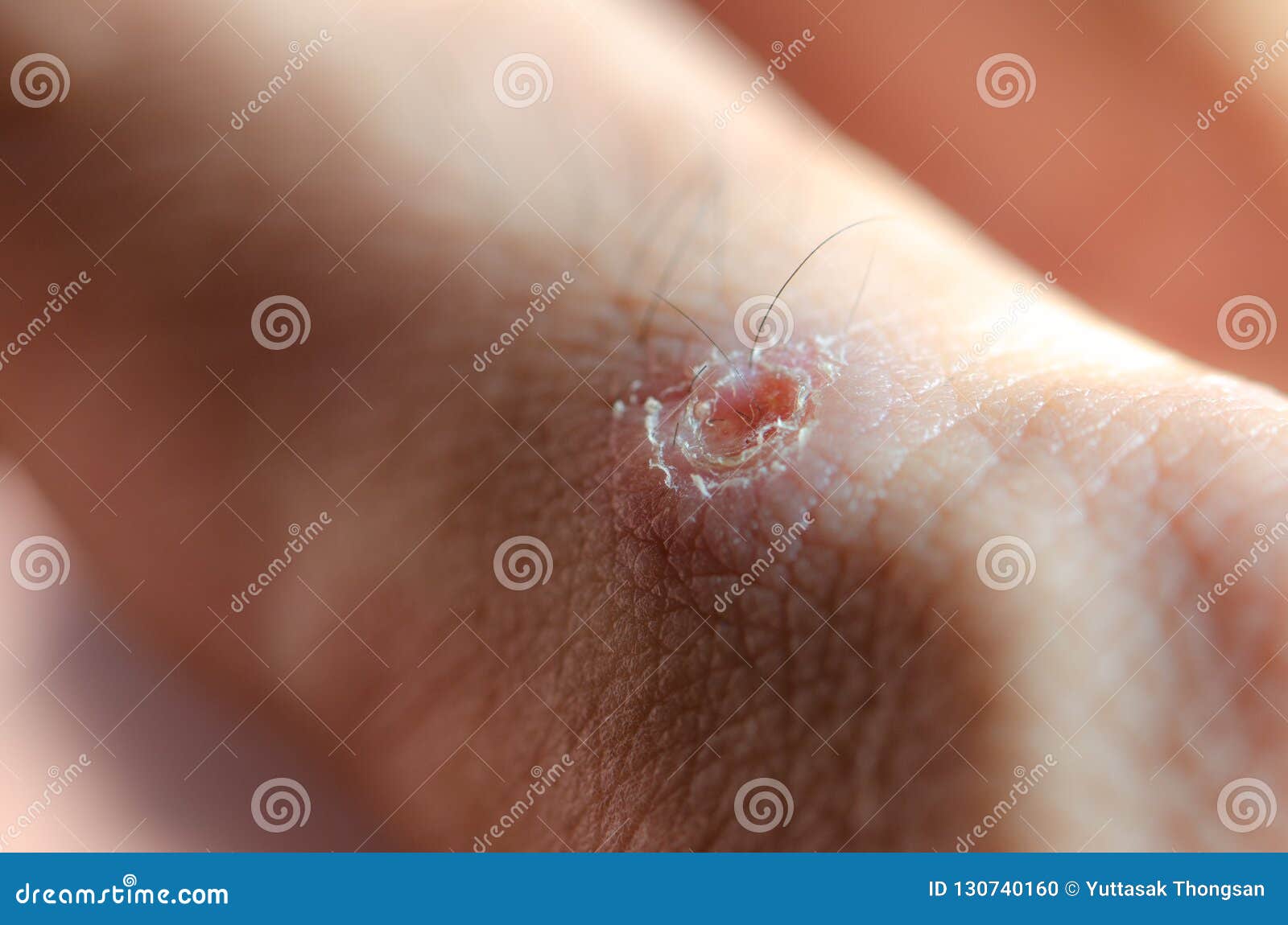 Abscess on Man Hand,select Focus. Stock Photo - Image of focus ...
