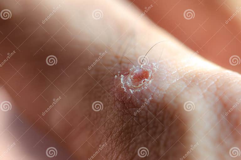 Abscess on Man Hand,select Focus. Stock Photo - Image of focus ...