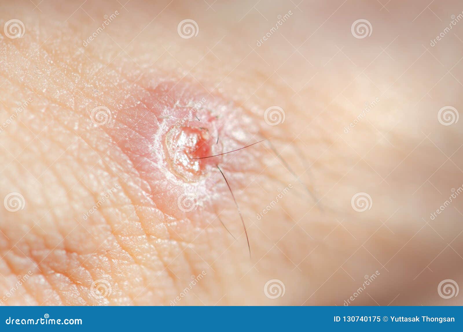 Abscess on Man Hand,select Focus. Stock Image - Image of focus, focusn ...