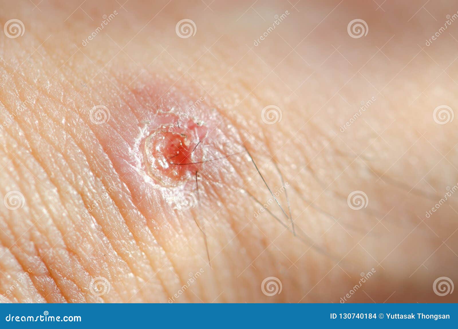Abscess on Man Hand,select Focus. Stock Photo - Image of closeup ...