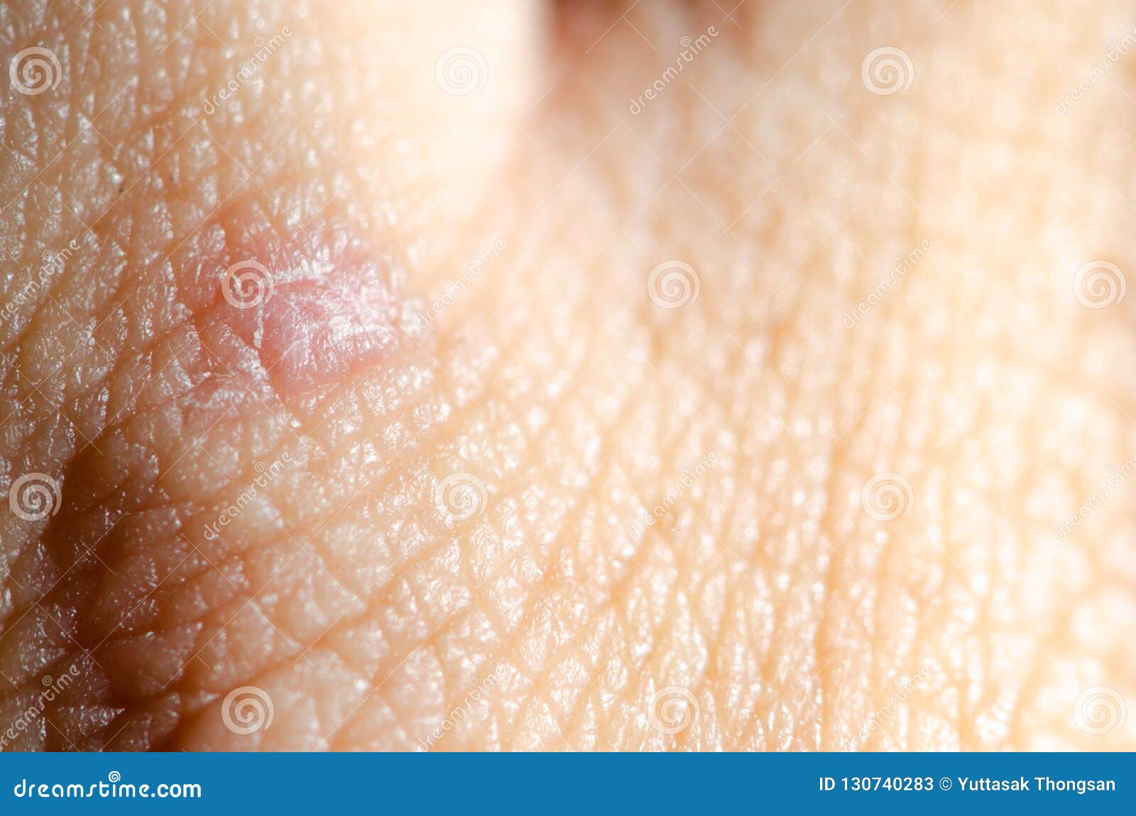 Abscess on Man Hand,select Focus. Stock Image - Image of artery ...