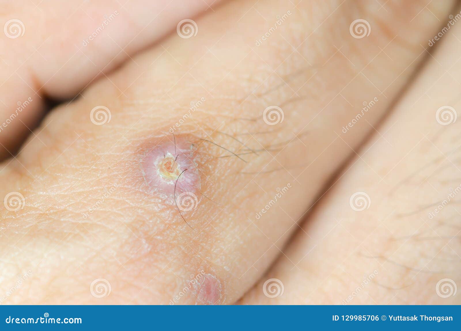 Abscess on Man Hand,select Focus. Stock Photo - Image of blood ...