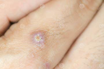 Abscess on Man Hand,select Focus. Stock Photo - Image of blood ...