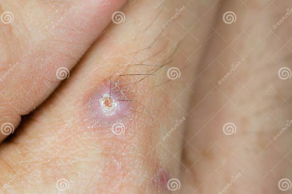 Abscess on Man Hand,select Focus. Stock Image - Image of inflammation ...