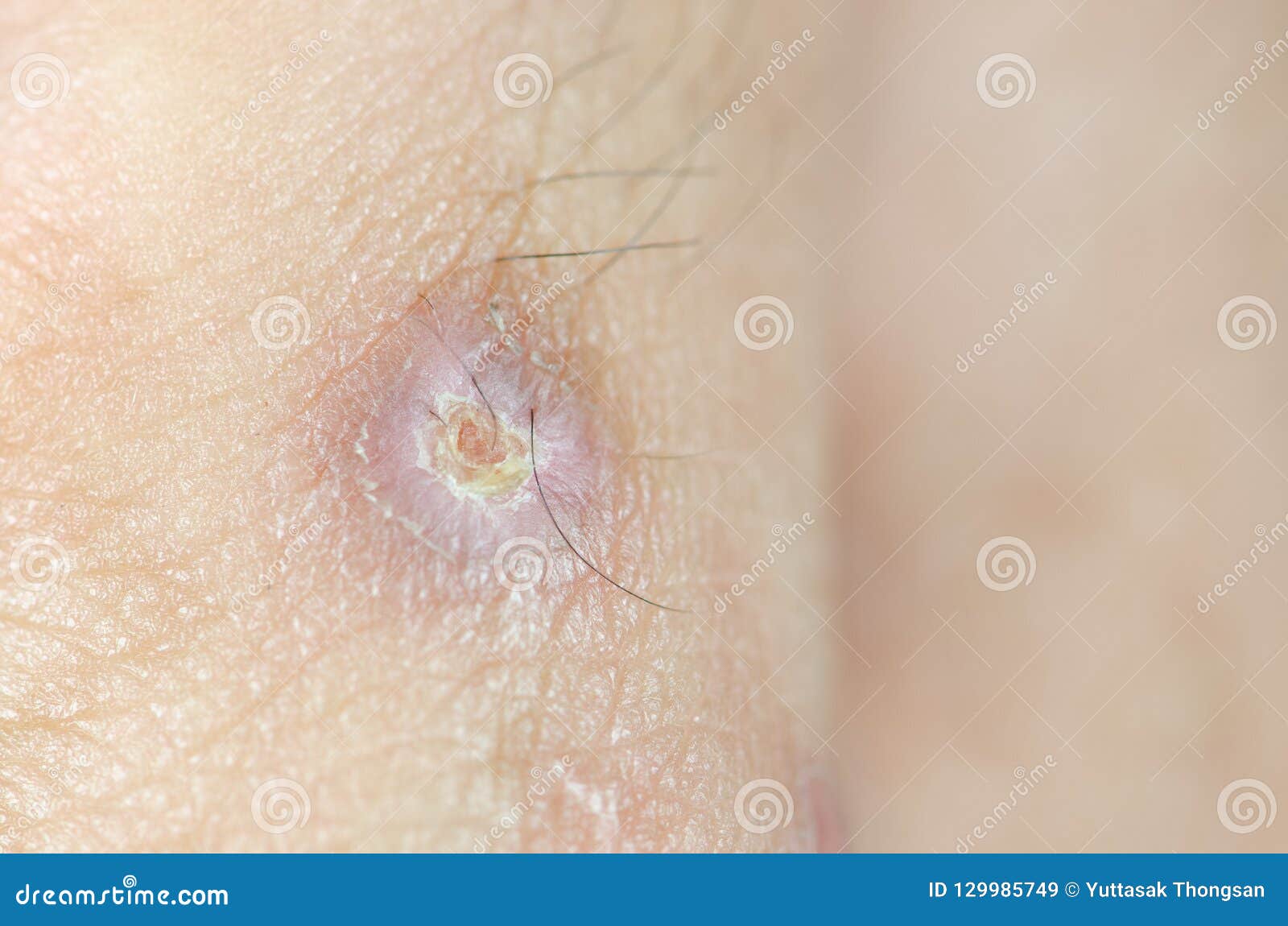Abscess on Man Hand,select Focus. Stock Image - Image of focusn ...