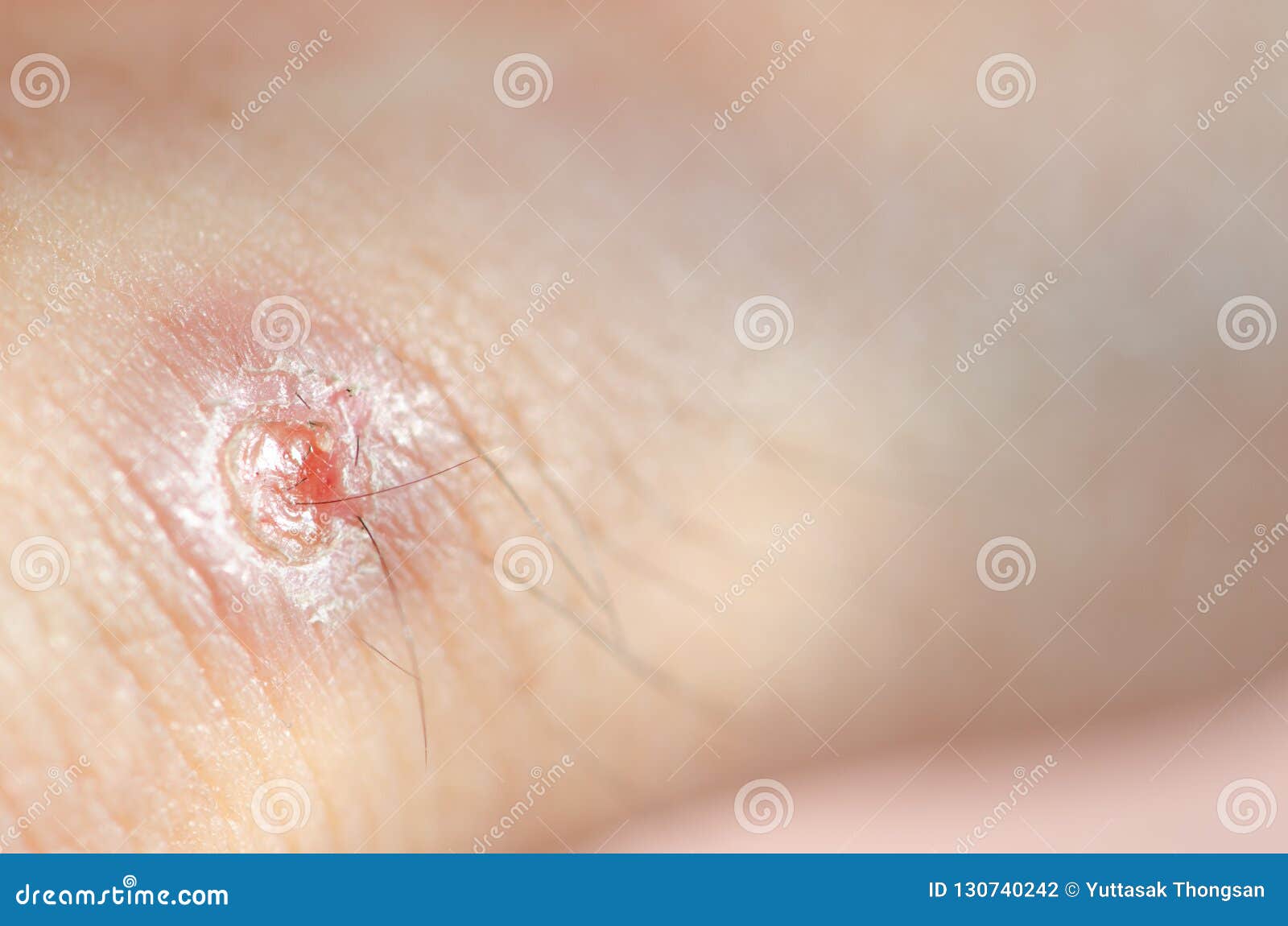 Abscess on Man Hand,select Focus. Stock Photo - Image of hospital, care ...